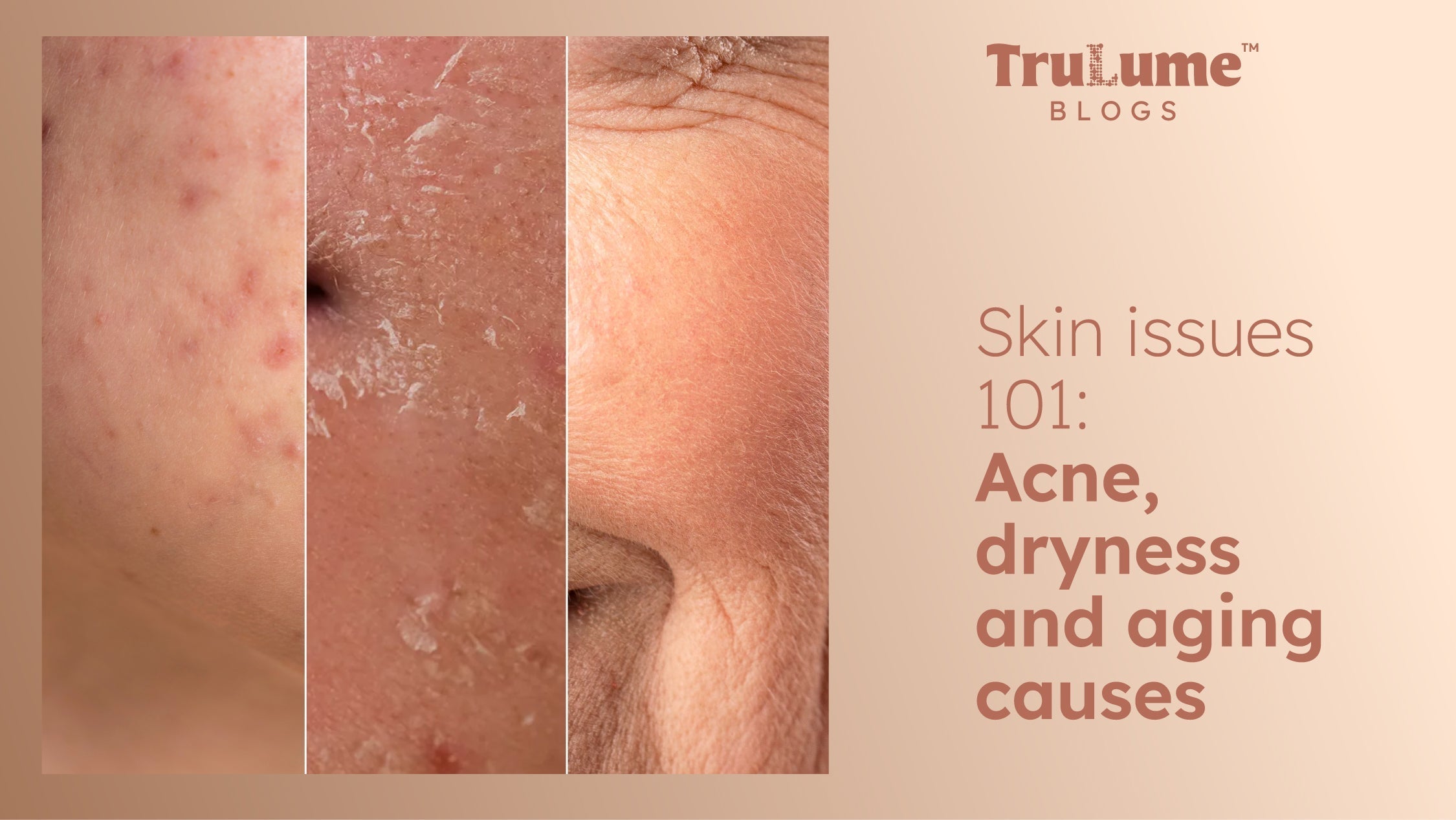 Skin Issues 101: Acne, Dryness & Aging Causes – TruLume